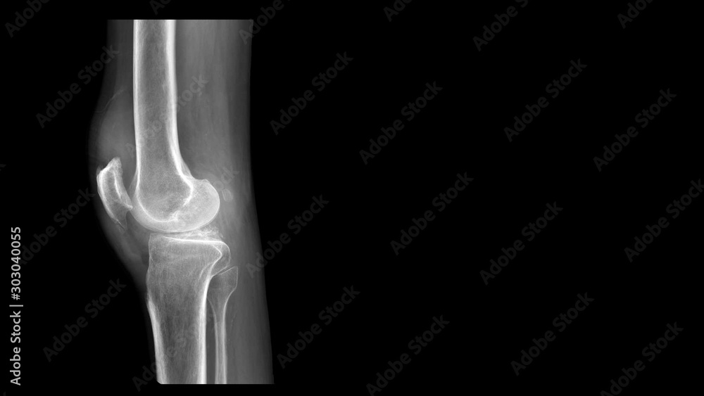 Film X ray knee radiograph show Os Fabella. Fabella is a small bone ...