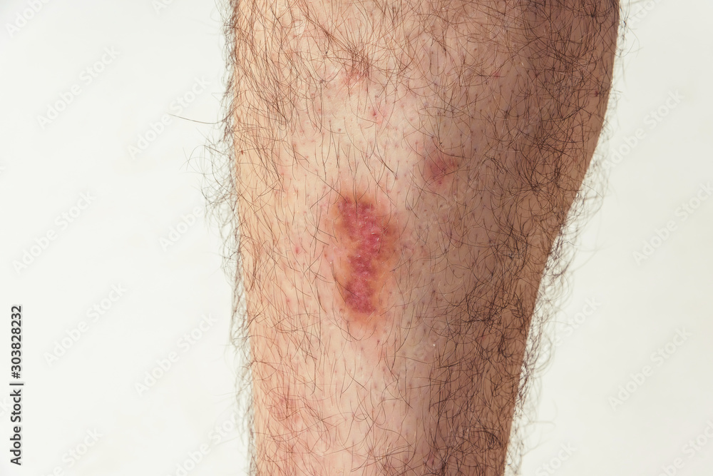 Skin injury after falling from a motorcycle on a man's leg. Skin ...