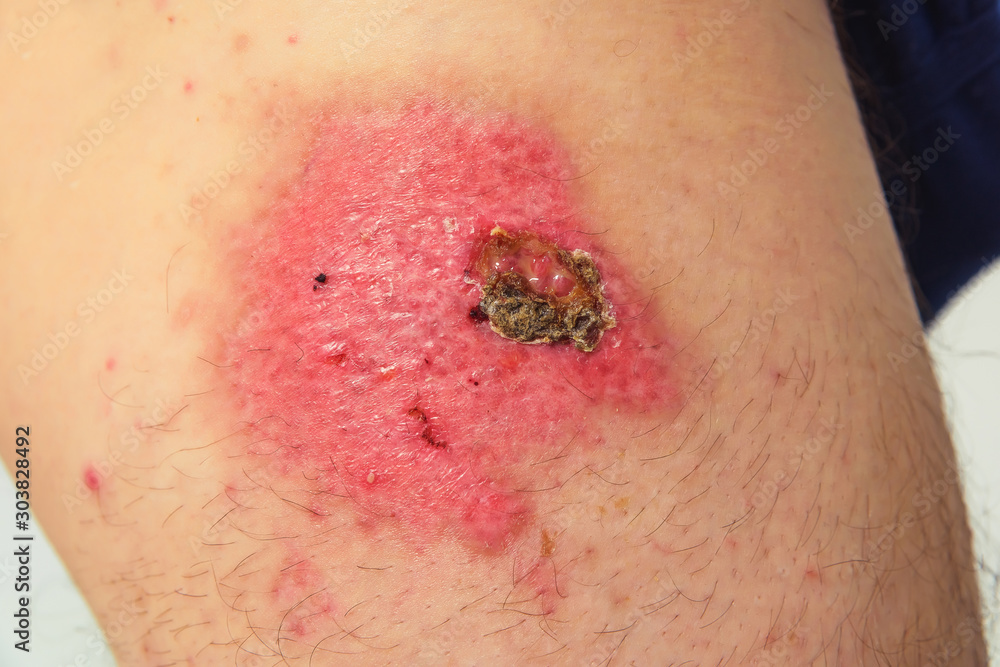 Stock-Foto „Skin injury after falling off a motorcycle. Skin lesions on ...