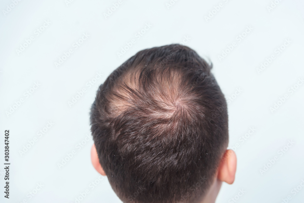 Early male pattern baldness. Hair loss in a young man. Beginning bald ...