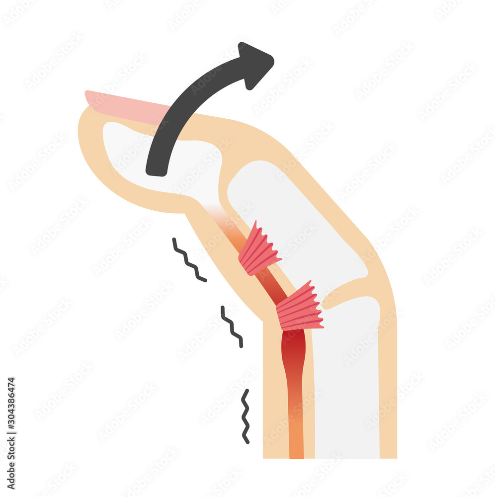 Trigger finger causes and symptoms illustration / when stretching Stock ...
