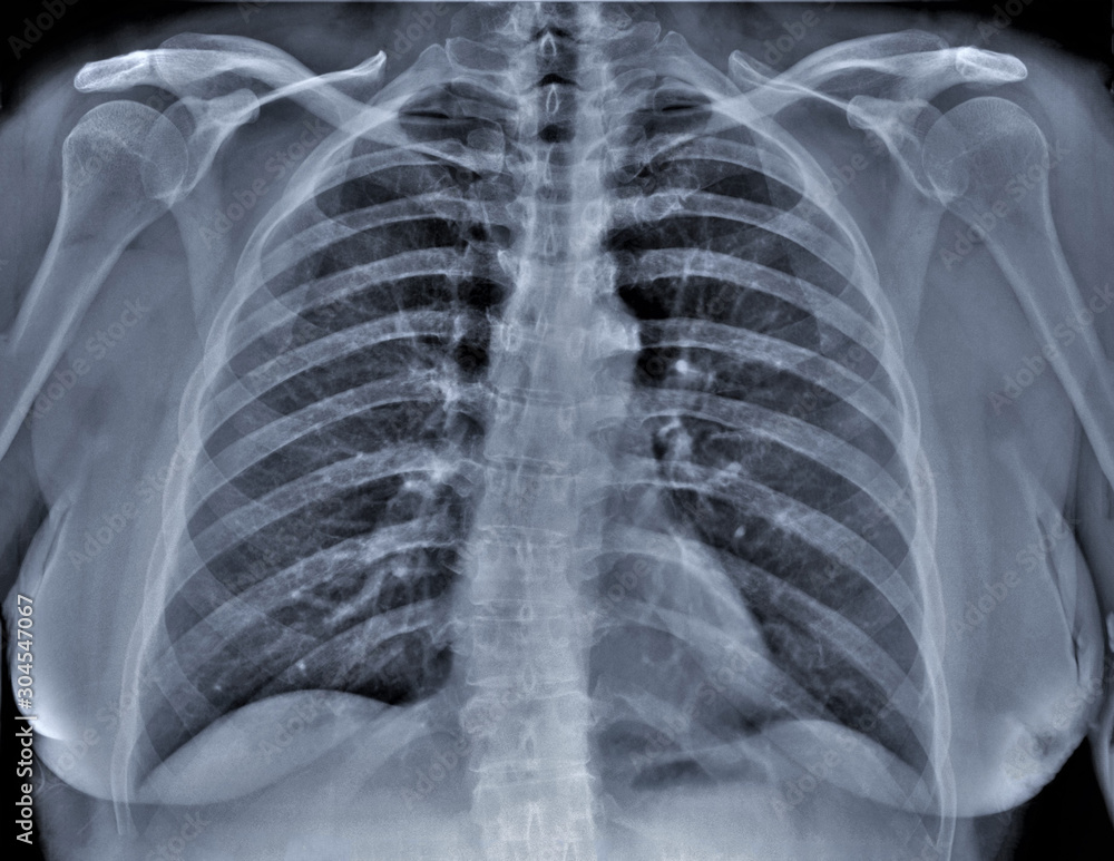normal radiography of chest organs in direct projection, Traumatology ...