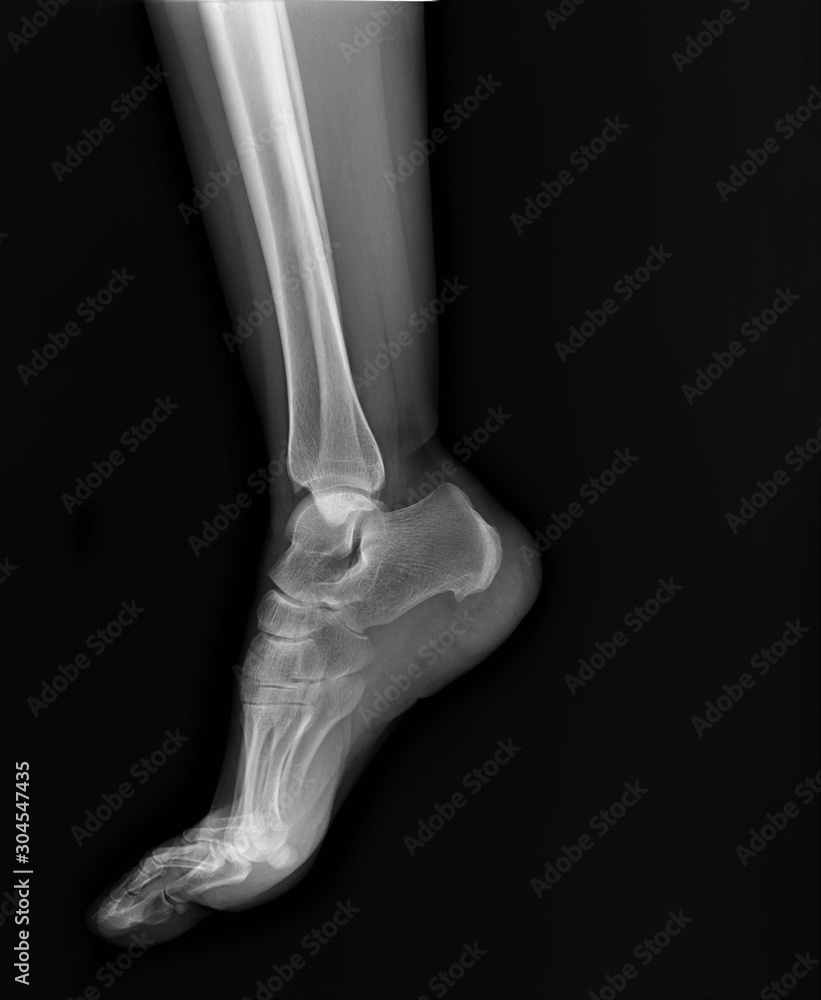 normal radiography of the ankle joint in lateral projection ...