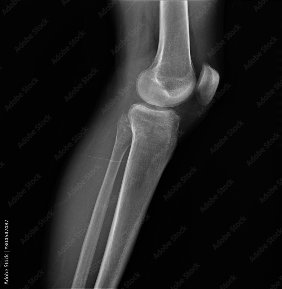 normal radiography of the knee joint in lateral projection, medical ...