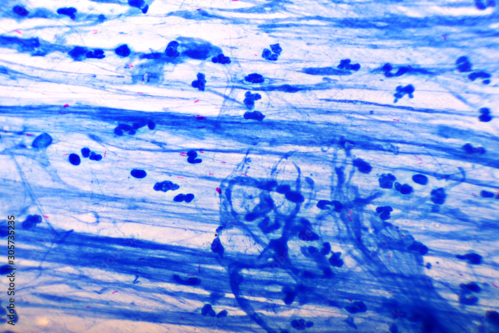 Mycobacterium tuberculosis positive (small red rod) in sputum smear ...