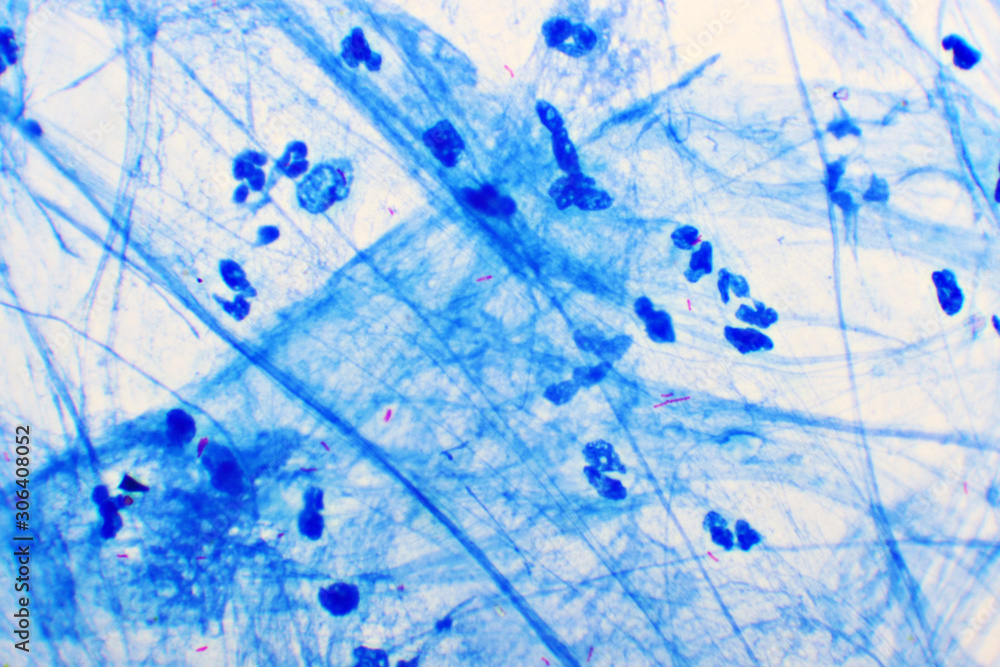 Mycobacterium tuberculosis positive (small red rod) in sputum smear ...