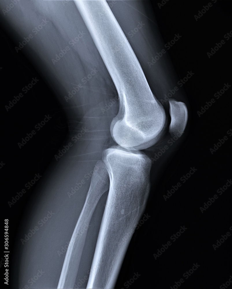 normal radiography of the knee joint in lateral projection, medical ...