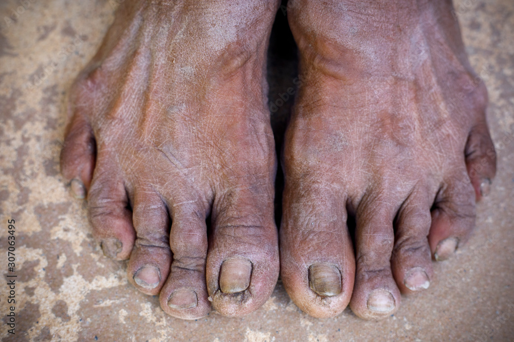 Dirty feet, wrinkled skin, abnormal toes Stock Photo | Adobe Stock
