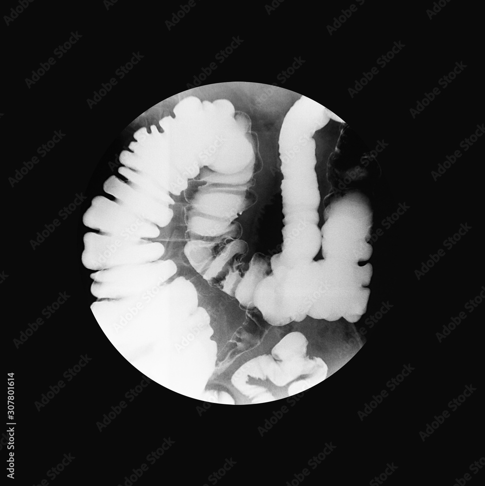 Fluoroscopic examination of lower gastrointestinal (GI) Tract, a spot ...