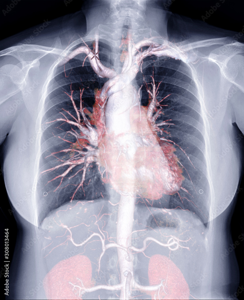 Chest X-ray with 3D rendering image CTA whole aorta inside the chest ...