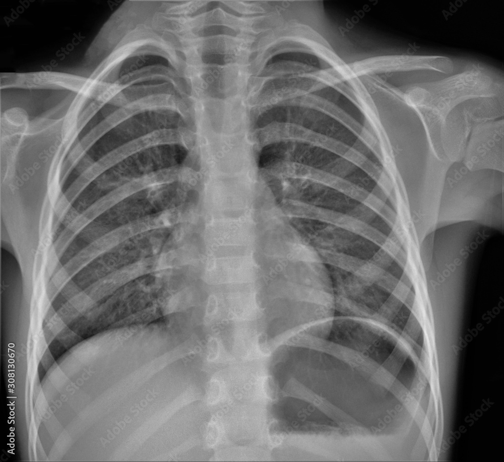 normal radiography of chest organs in direct projection, pulmonology ...