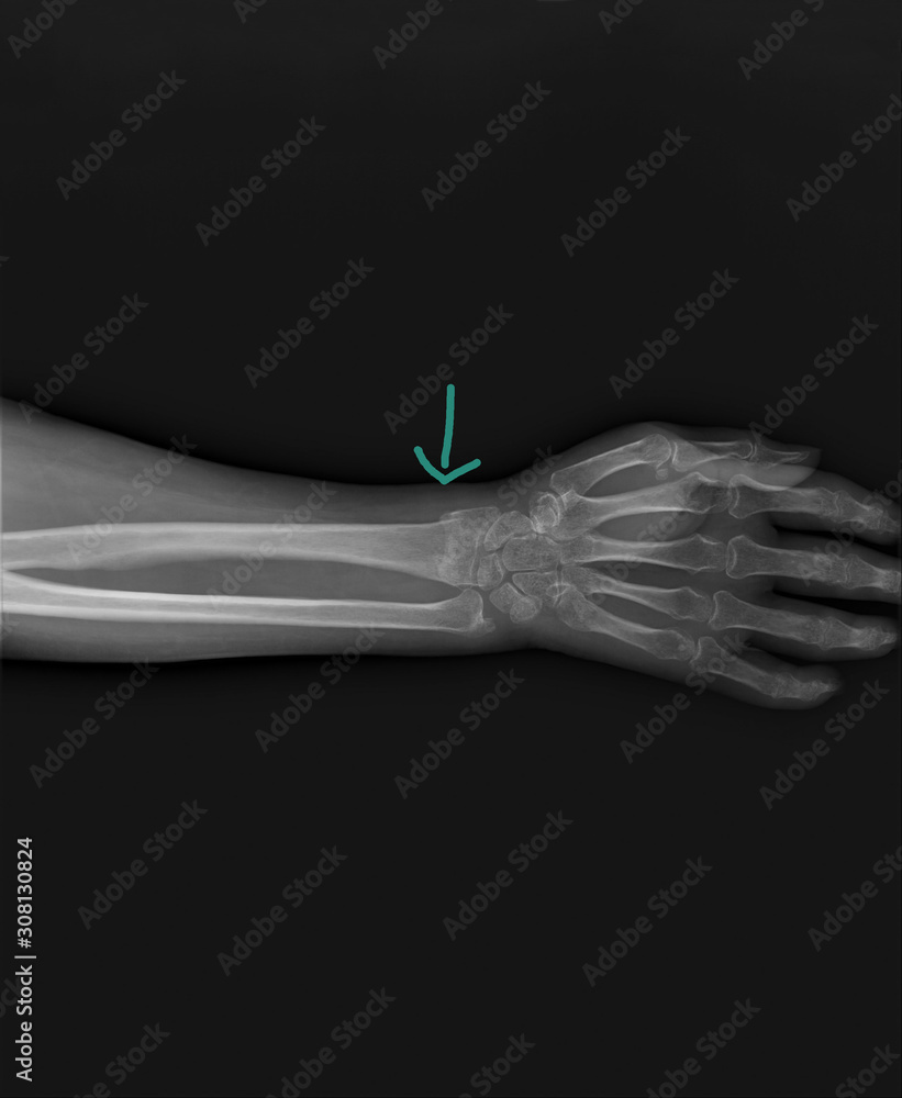radiography of forearm and wrist bones with a fracture of the distal ...