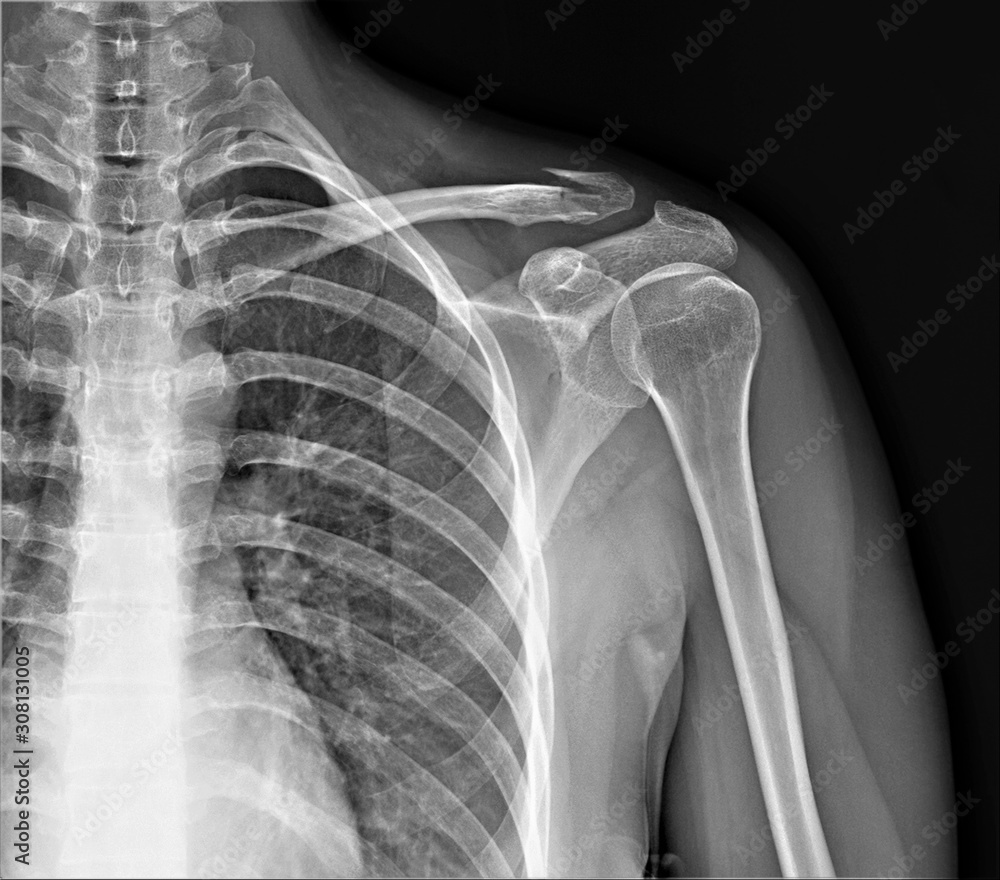 radiography of the shoulder joint and ribs in direct projection with a ...