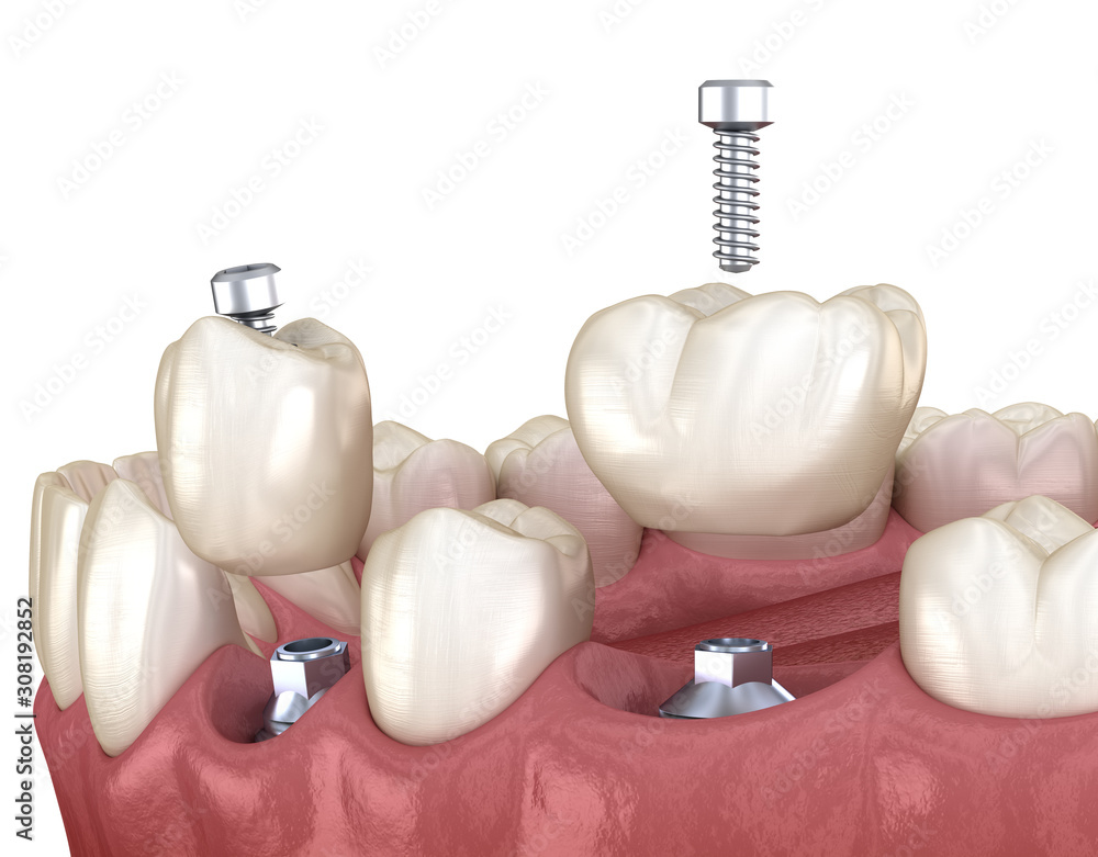 Premolar And Molar Tooth Crown Installation Over Implant Screw 5354