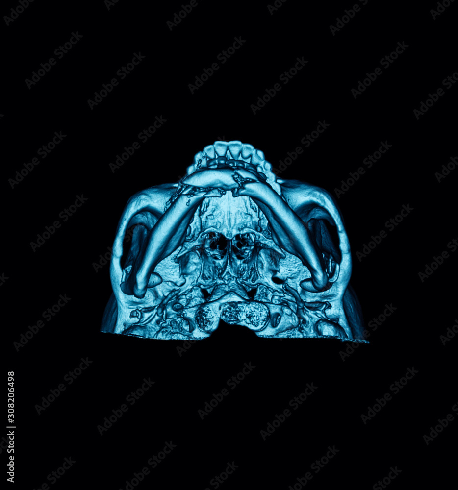 CT scan (computed tomography) of facial bone, axial view, showing ...