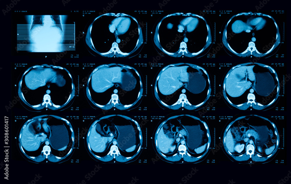 Computed tomography (CT scan) of upper abdomen with contrast media, a ...