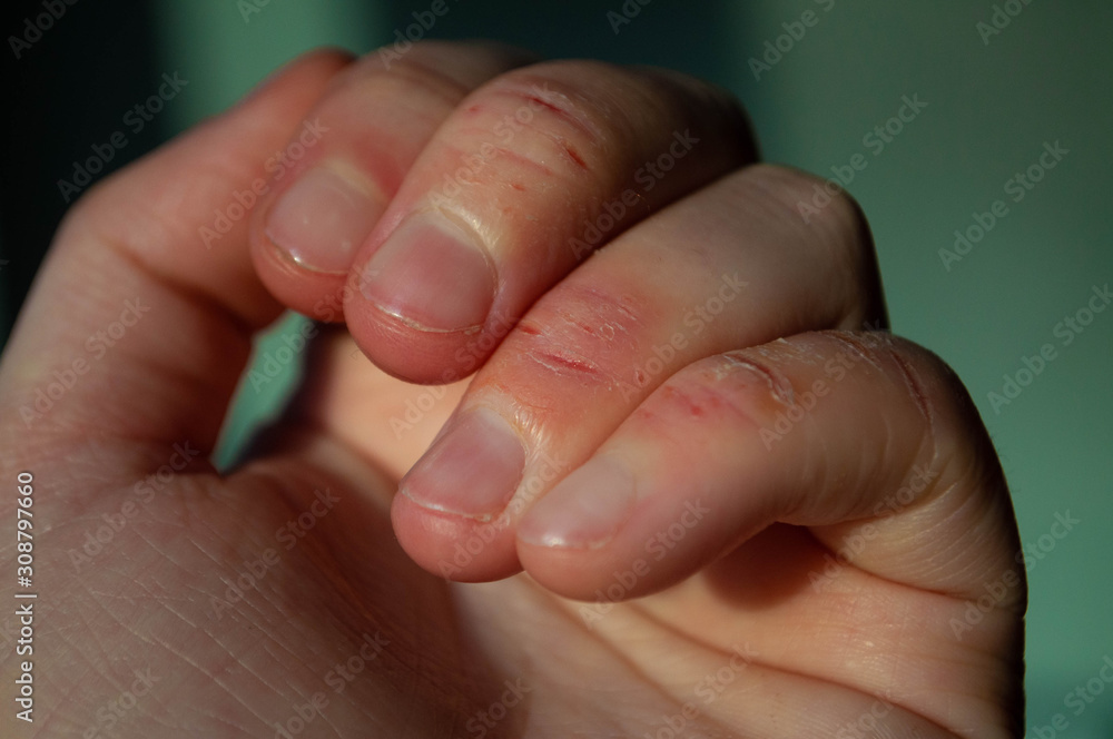 Stock-Foto „Hand eczema. Contact/atopic dermatitis on fingers. Itchy ...