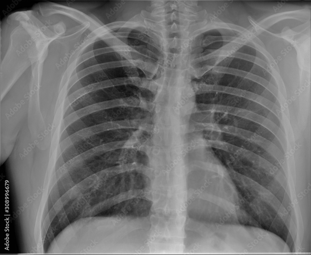 chest x-ray, pneumonia, emphysema, pulmonology, diagnosis of diseases ...