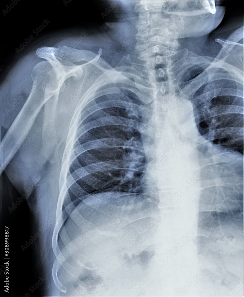 chest x-ray, pneumonia, emphysema, pulmonology, diagnosis of diseases ...