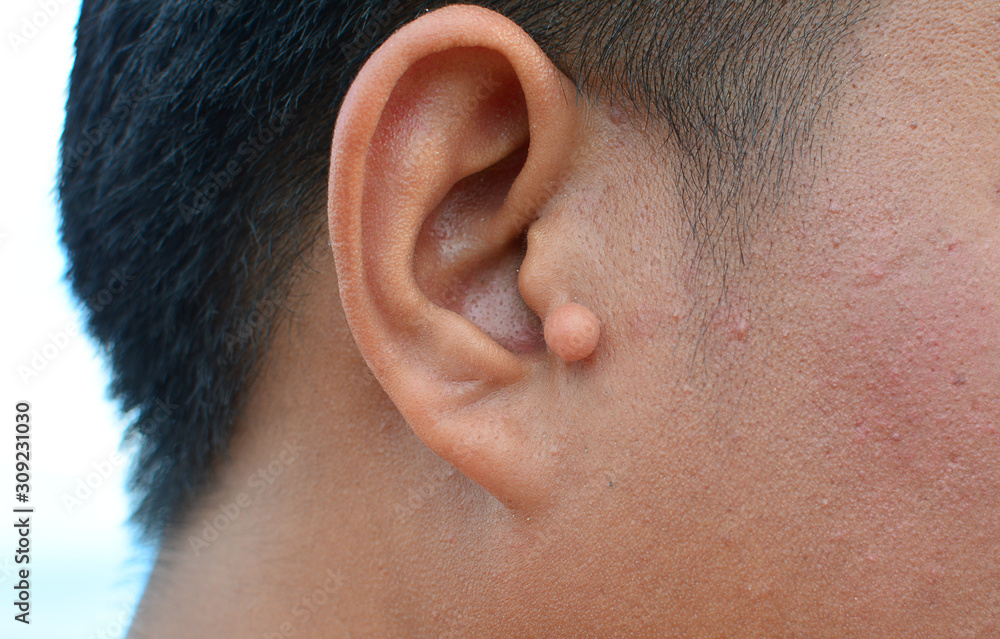 Scar Keloid ear ball shaped. hypertrophic scar on man ear. Can used for ...