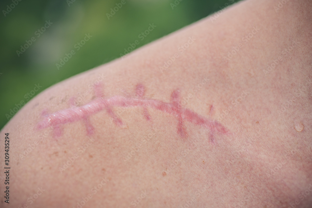 Scarring. Scar on the shoulder after injury. Mark on the body ...