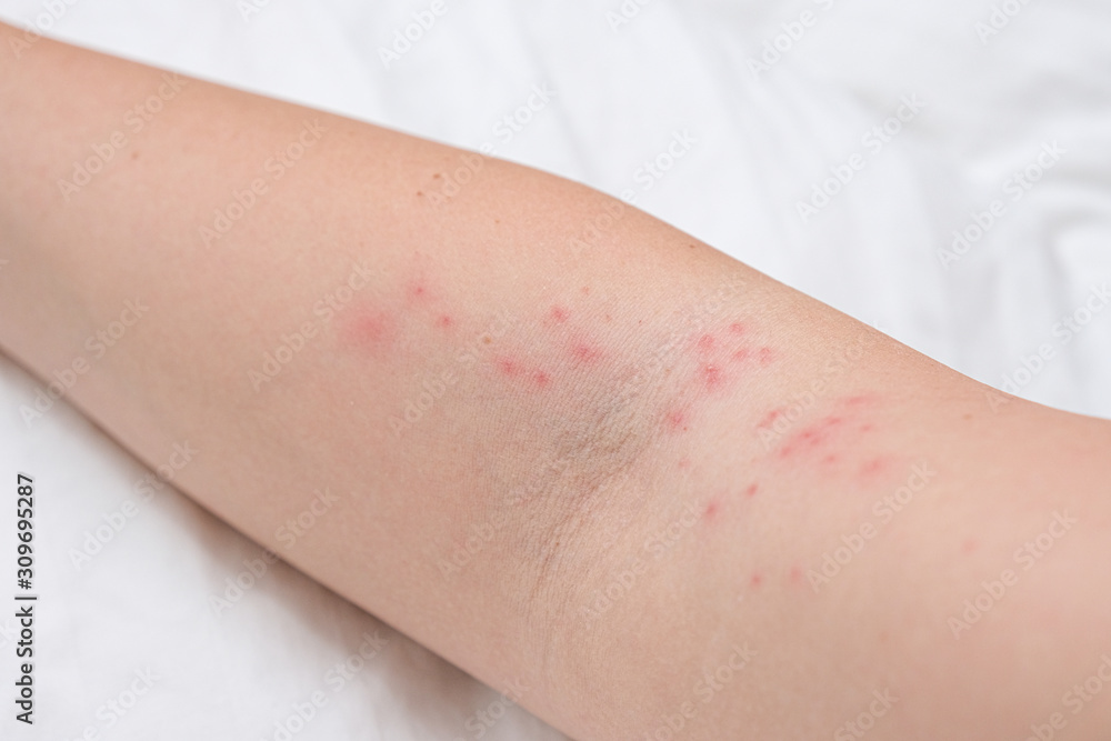 Foto de Stock Skin rash on female arm, itchy pimples as a result of an ...