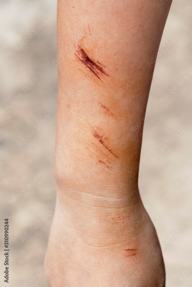 The wound form scabs on hand and arm. The wound happen during woman ...
