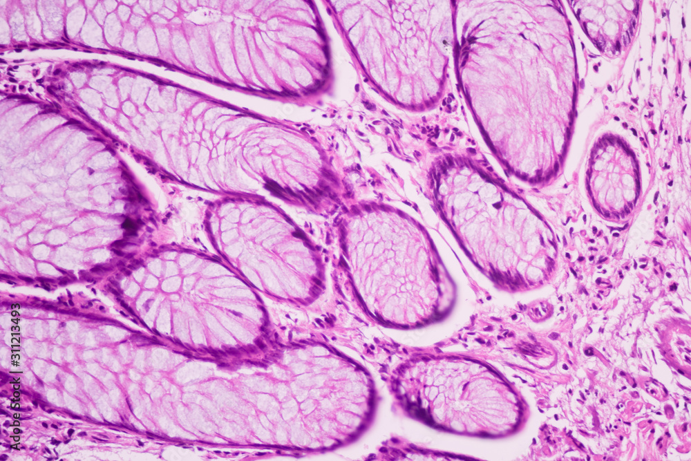 View in microscopic of ductal cell carcinoma, adenonocarcinoma from ...