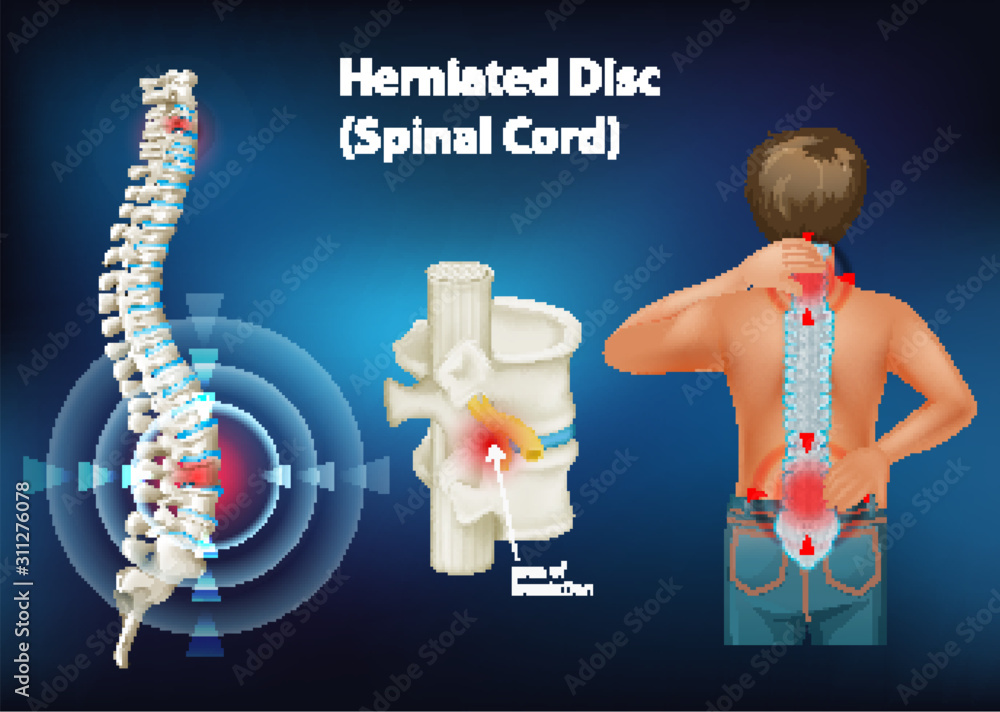 Diagram showing herniated disc Stock Vector | Adobe Stock