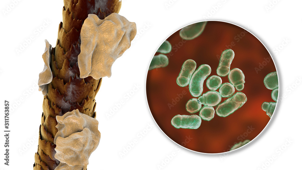 Human hair with dandruff and close-up view of microscopic fungi ...