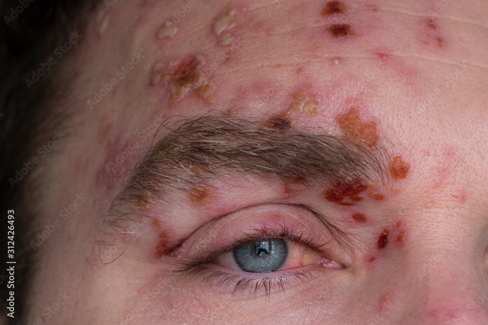 Foto de Stock face of a man suffering from herpes zoster on the 7th day ...