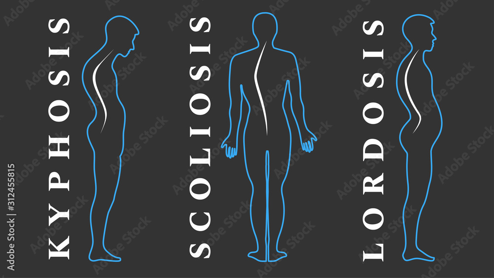 Diseases of the spine. Scoliosis, lordosis, kyphosis. Body posture ...