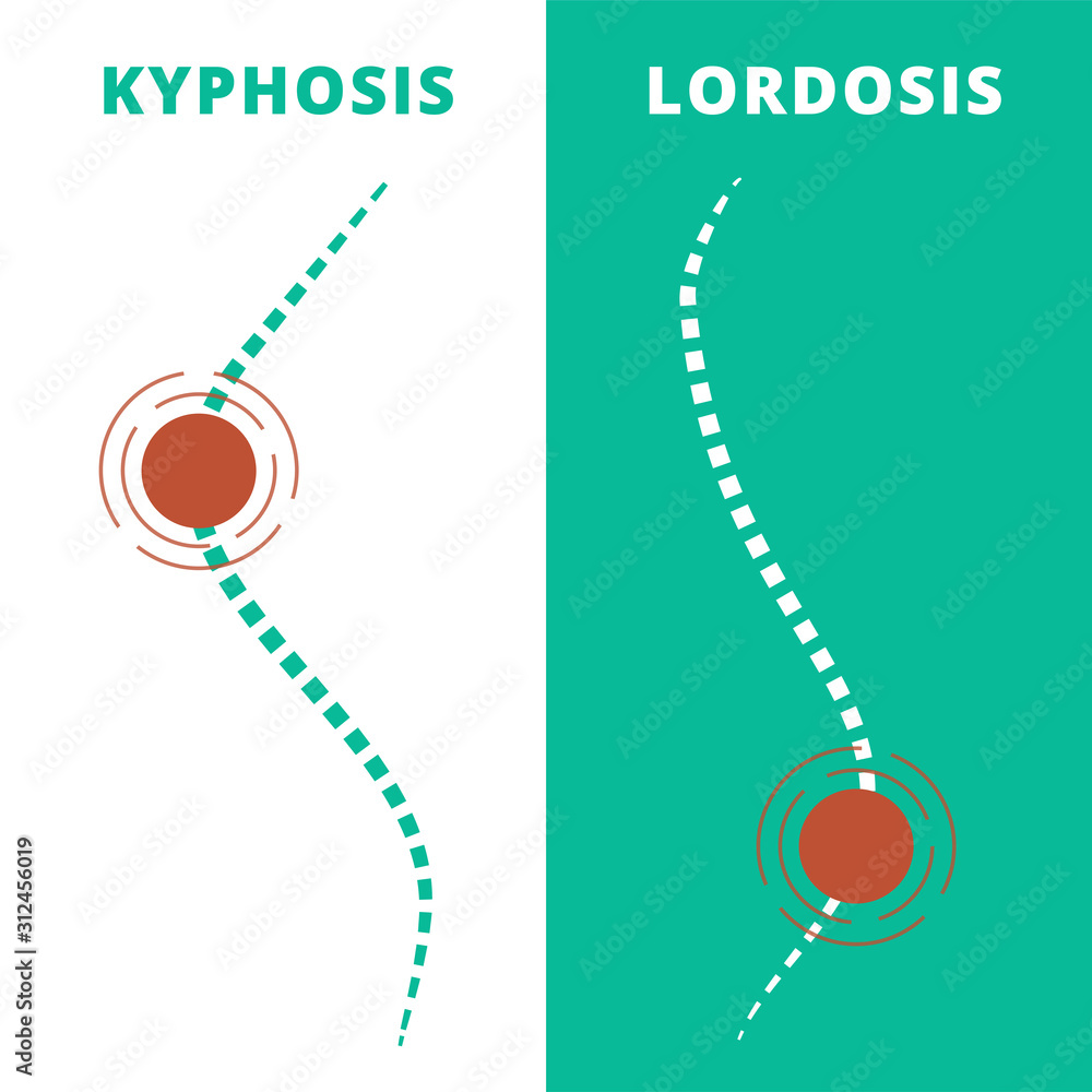 Diseases of the spine. Spinal pain. Lordosis, kyphosis. Body posture ...