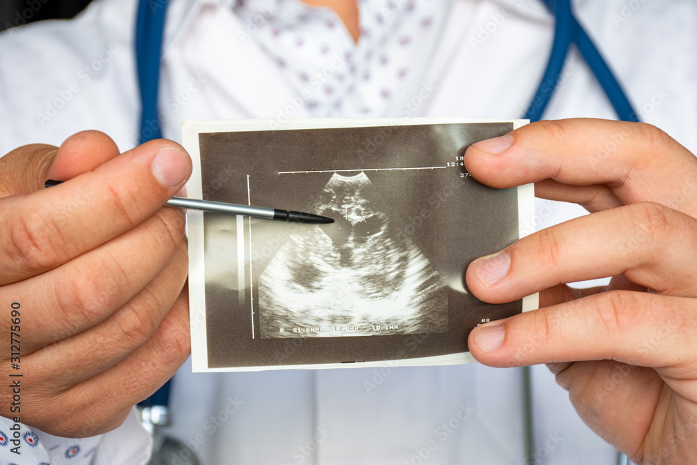 Heart ventricular dilation on ultrasound image concept photo. Doctor ...