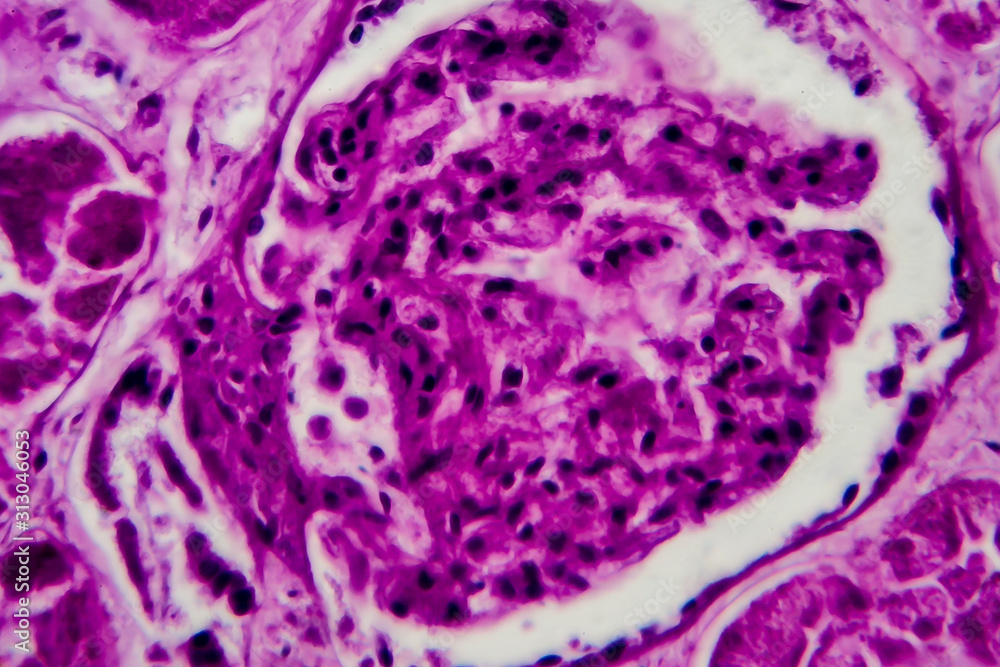 Stockfotot Diffuse proliferative glomerulonephritis, DPGN, light ...