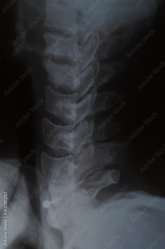 Magnetic resonance image of human spine. X-ray of the spinal column ...