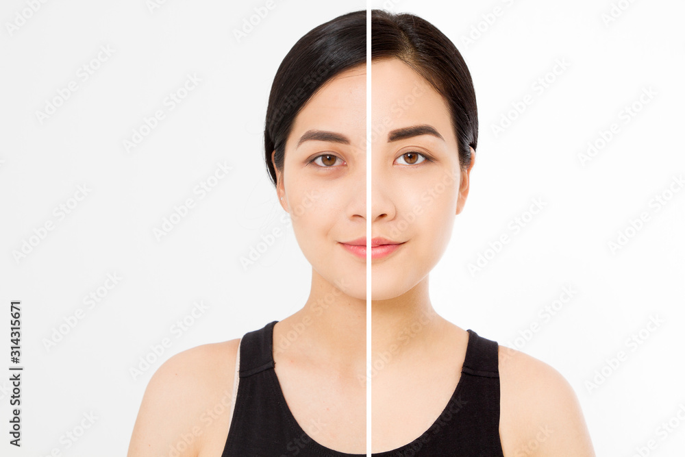 Closeup before after asian woman face. Before-after cosmetic procedures ...
