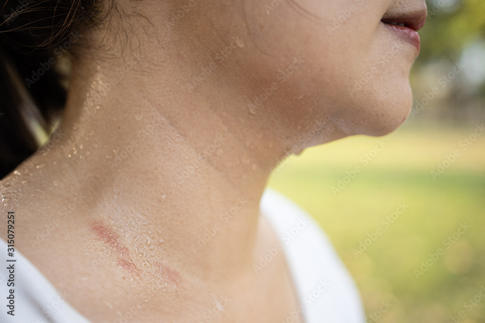 Foto de Stock Female neck with sweat on skin,asian woman with atopic ...