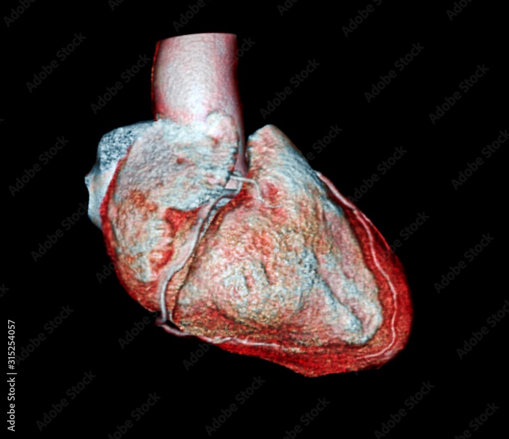 Coronary arteries, CT scan Stock Photo | Adobe Stock