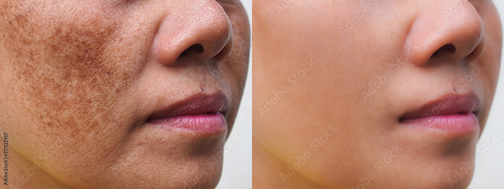 Image before and after spot melasma pigmentation facial treatment on ...