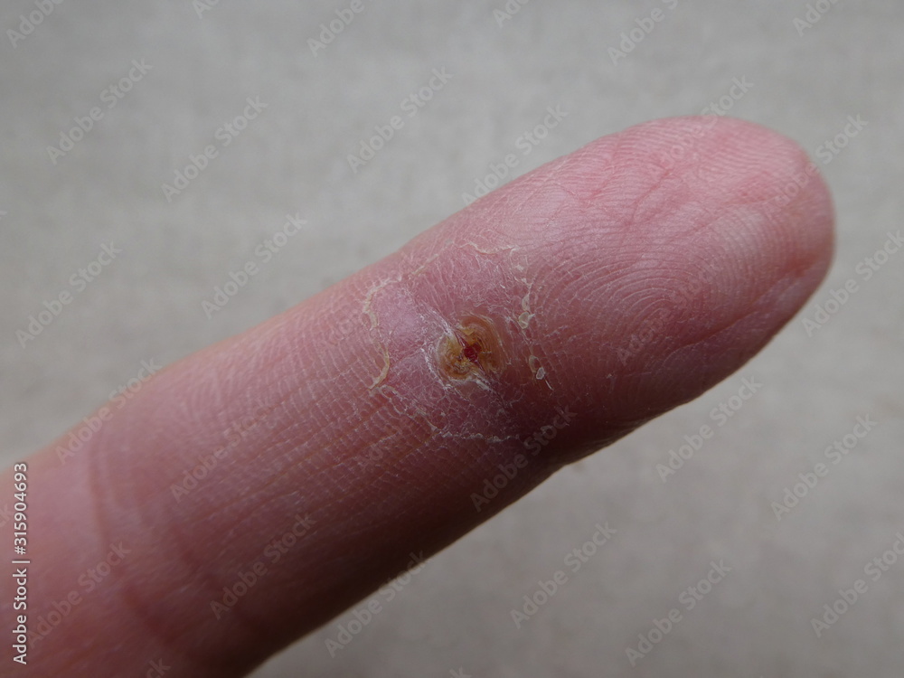 Finger with wound from injured after burn on the skin Stock Photo ...