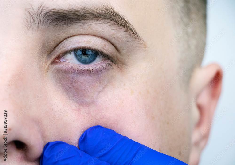 Bags under the eyes, hernias on the face of a man. Plastic surgeon ...