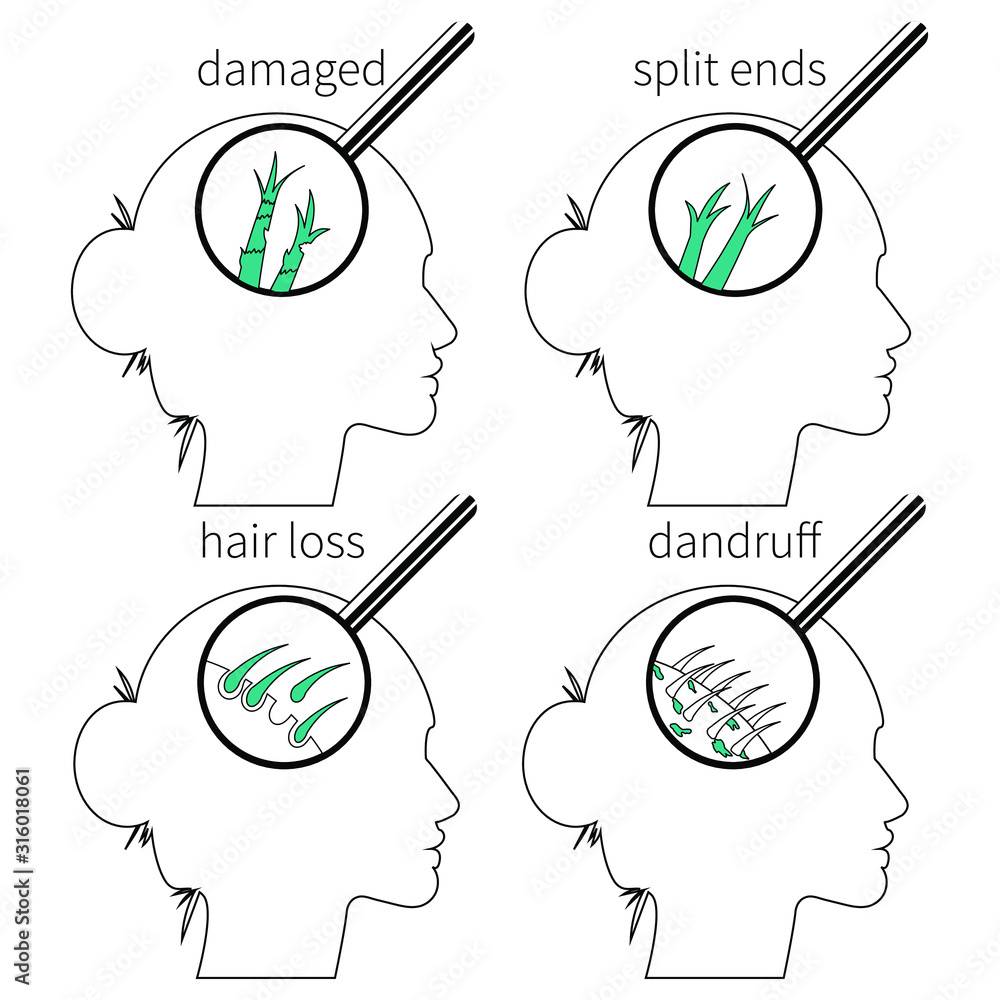 Hair problems set of line silhouette illustrations. Scheme for ...
