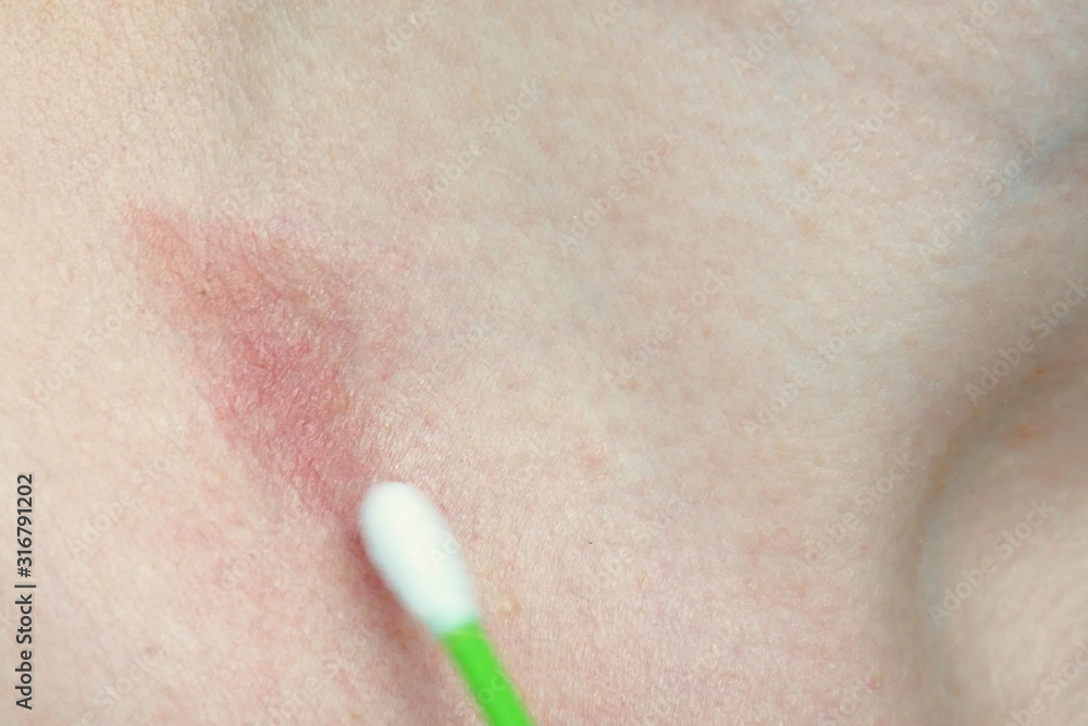 skin rash treatment on woman neck. Shingles, Disease, Herpes zoster ...