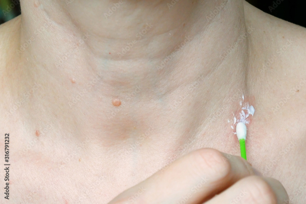 skin rash treatment on woman neck. Shingles, Disease, Herpes zoster ...