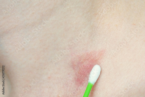 skin rash treatment on woman neck. Shingles, Disease, Herpes zoster ...