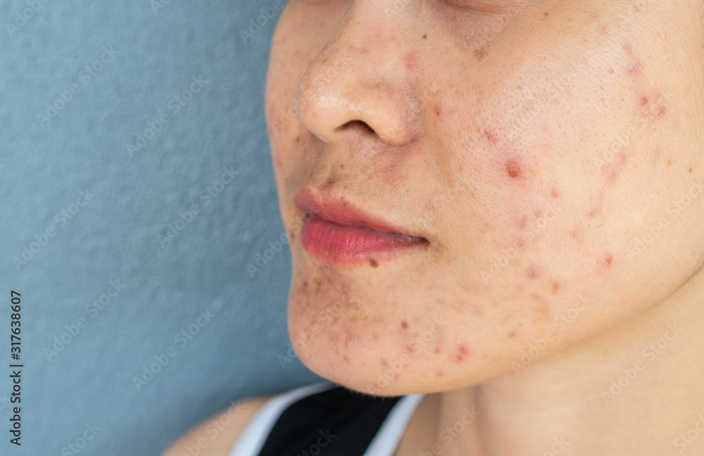 Close-up of woman half face with problems of acne inflammation (Papule ...