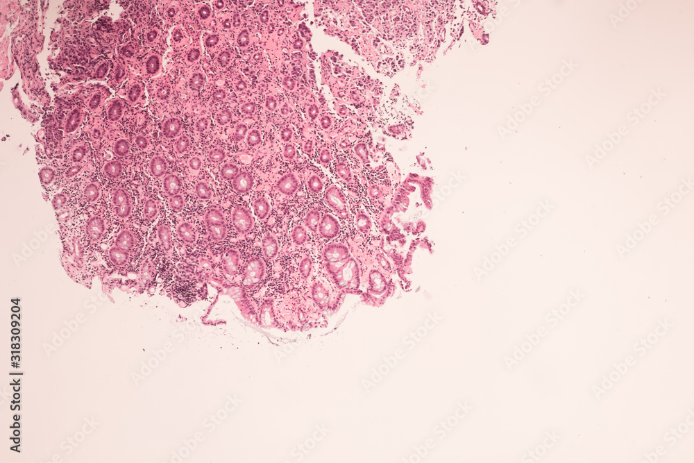 View in microscopic of ductal cell carcinoma, adenonocarcinoma from ...