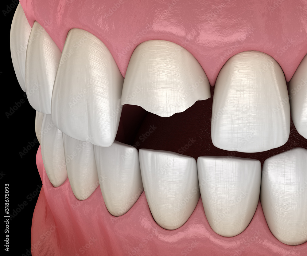 Broken central incisor tooth. Medically accurate 3D illustration of ...