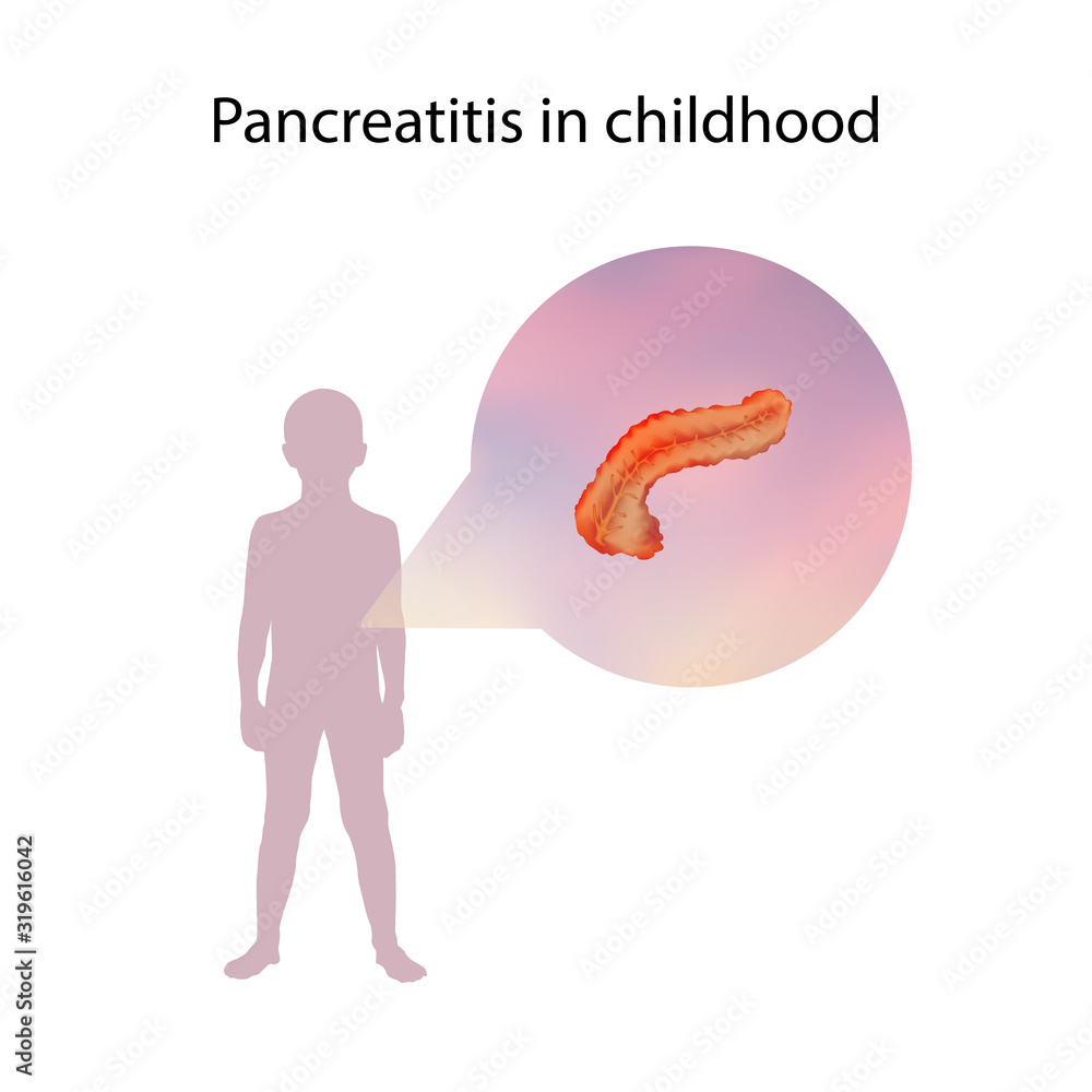Pancreas pain, inflammation, pancreatitis in childhood. Medical anatomy ...